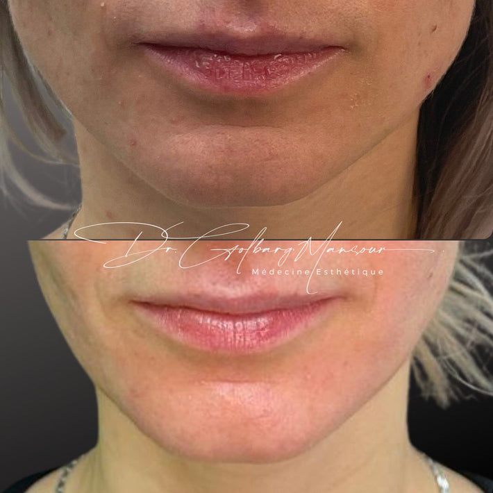 Injections Botox Masseter Montréal – Clinique Esthétique HoMa