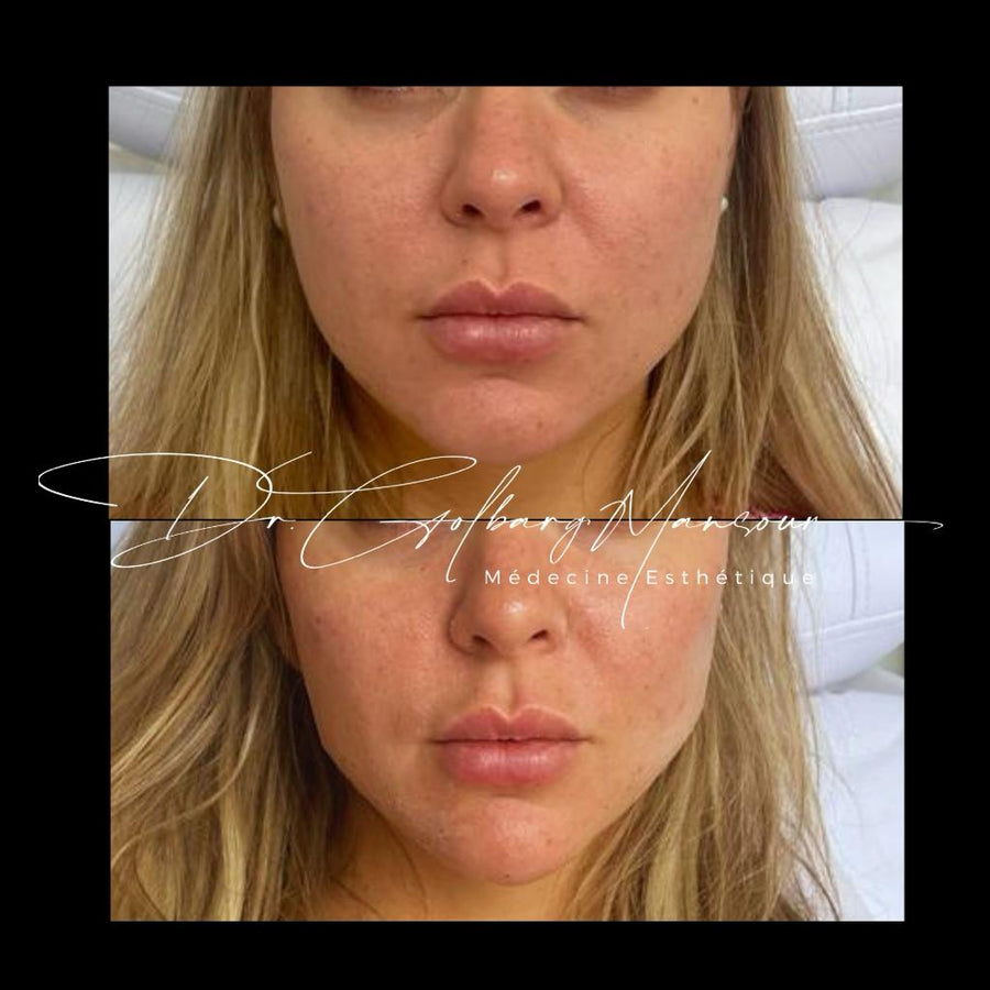 Masseter Botox Injections Montreal – Clinique Esthétique HoMa