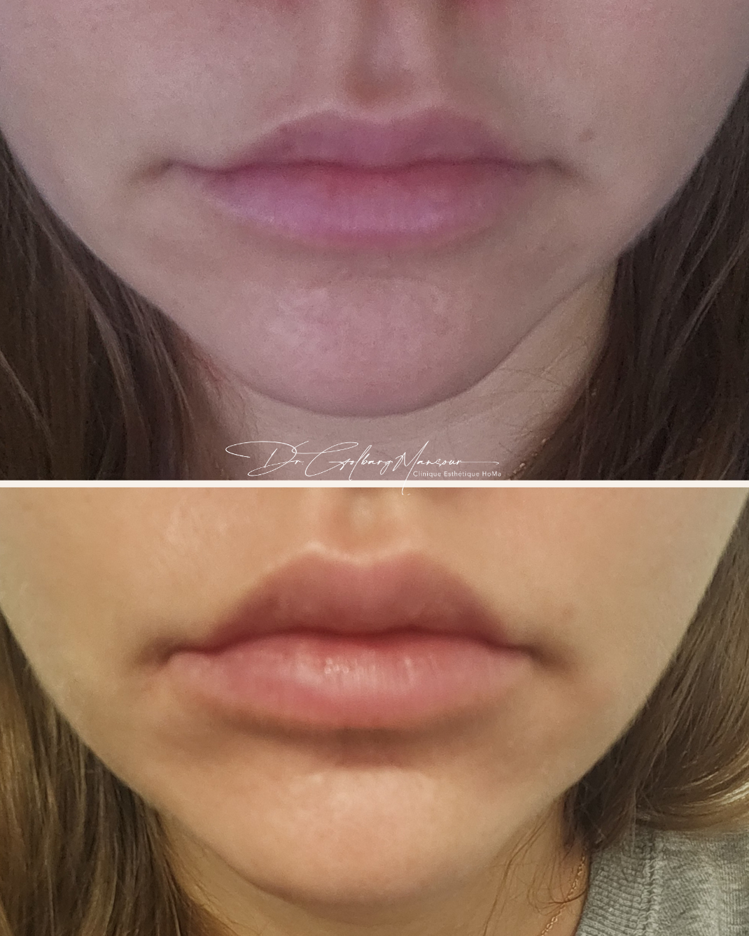 Botox Lip Flip In Montreal Clinique Esthétique Homa