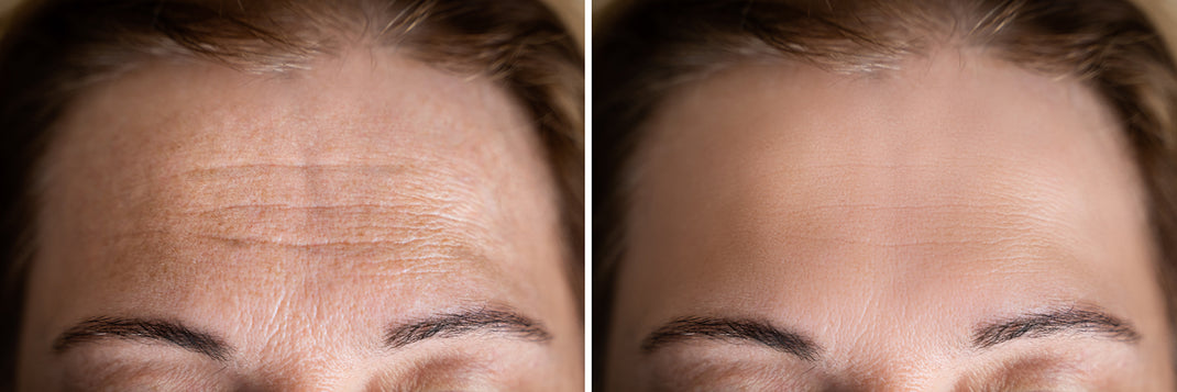 Forehead Lines Botox injections in Montreal – Clinique Esthétique HoMa