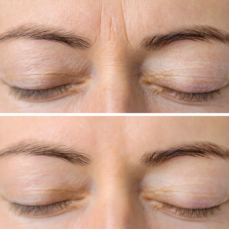 Best Glabella Botox Injections in Montreal – Clinique Esthétique HoMa